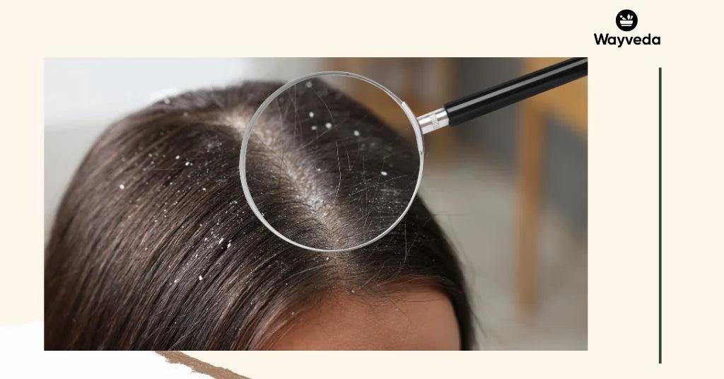 15 Ways To Cure Dandruff - Best Home Remedies And Ways – Wayveda